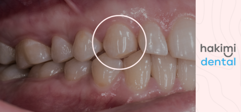 What is an Eye Tooth? Care, Issues, and Treatments