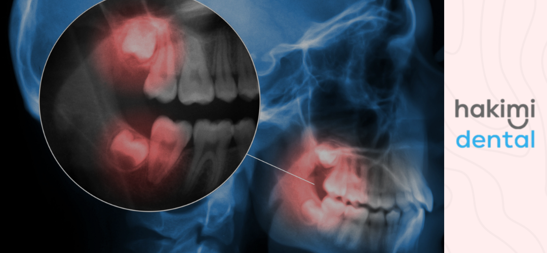 When to See a Dentist About Wisdom Tooth Pain