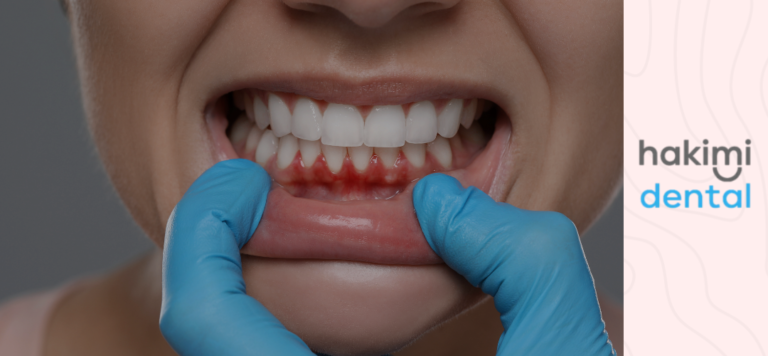 Lump on Gum: Causes, Diagnosis & Expert Treatment