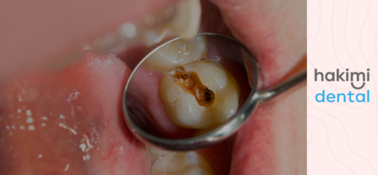 Understanding and Treating Dental Caries | Hakimi Dental Clinic