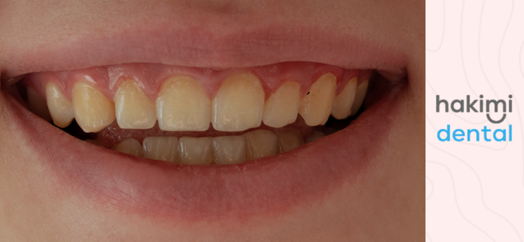 Black Spot on Tooth: Causes, Treatment & Prevention